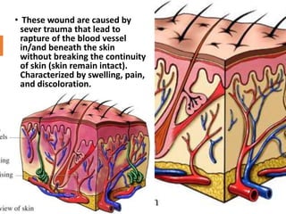 Subcutaneous wounds bruises and Contusions .pptx | First Aid | Injuries