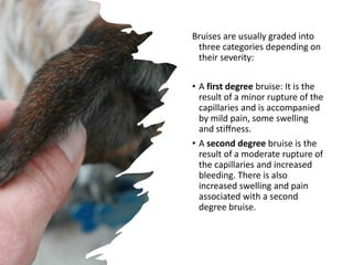 Subcutaneous wounds bruises and Contusions .pptx