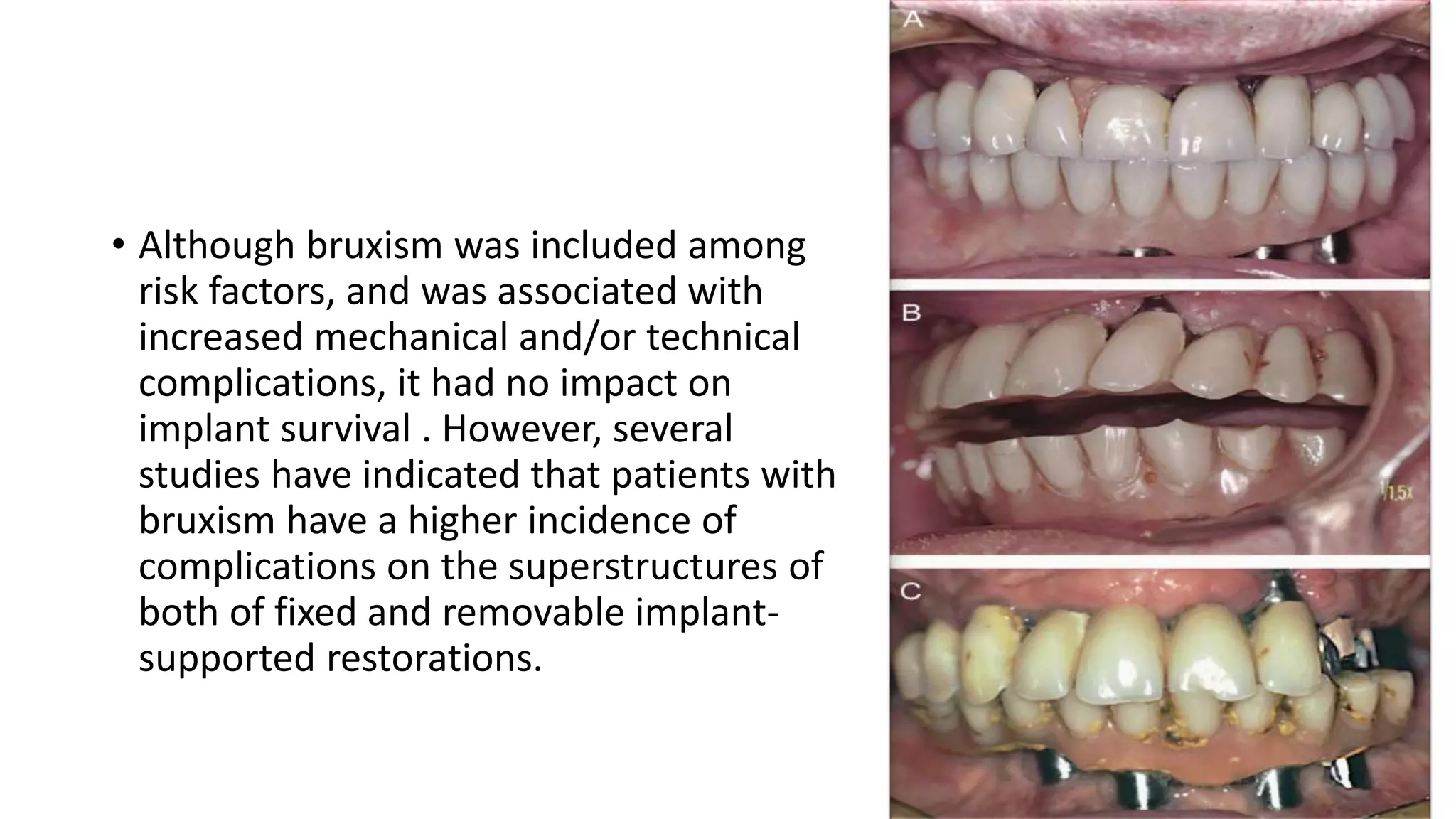 Bruxism and its prosthetic treatment: a critical review | PPTX