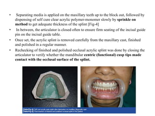 Bruxism and its management | PPTX