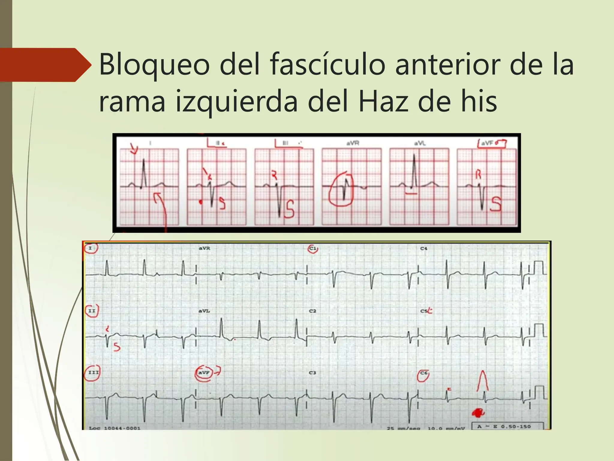 BLOQUEOS DE RAMAS Y FASCICULARES ANTERIOR Y POSTERIOR | PPTX