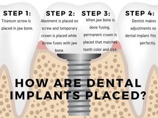 Dental Implants: Your Guide | PDF
