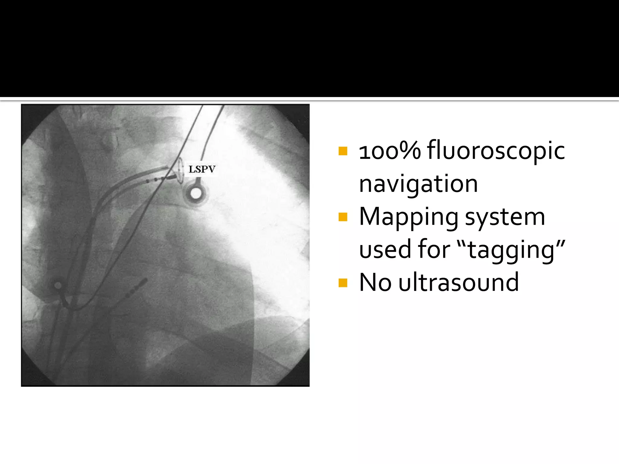 Atrial Fibrillation Ablation - Improving Efficacy and Minimizing ...
