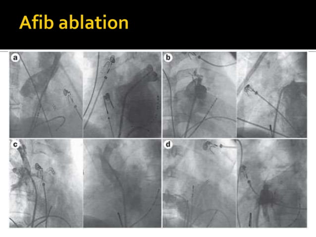 Atrial Fibrillation Ablation - Improving Efficacy and Minimizing ...