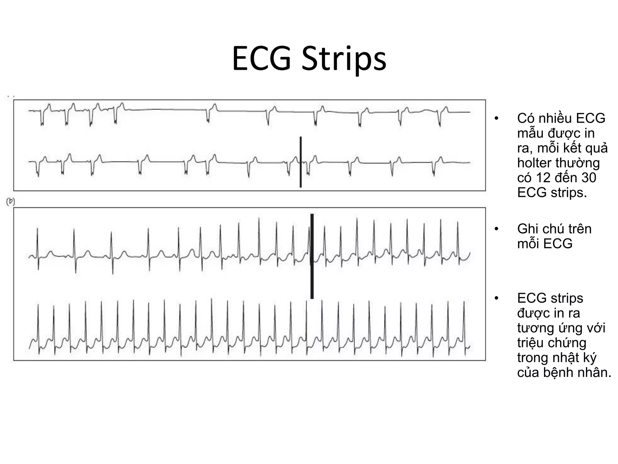 Đọc Holter ECG 24h | PDF