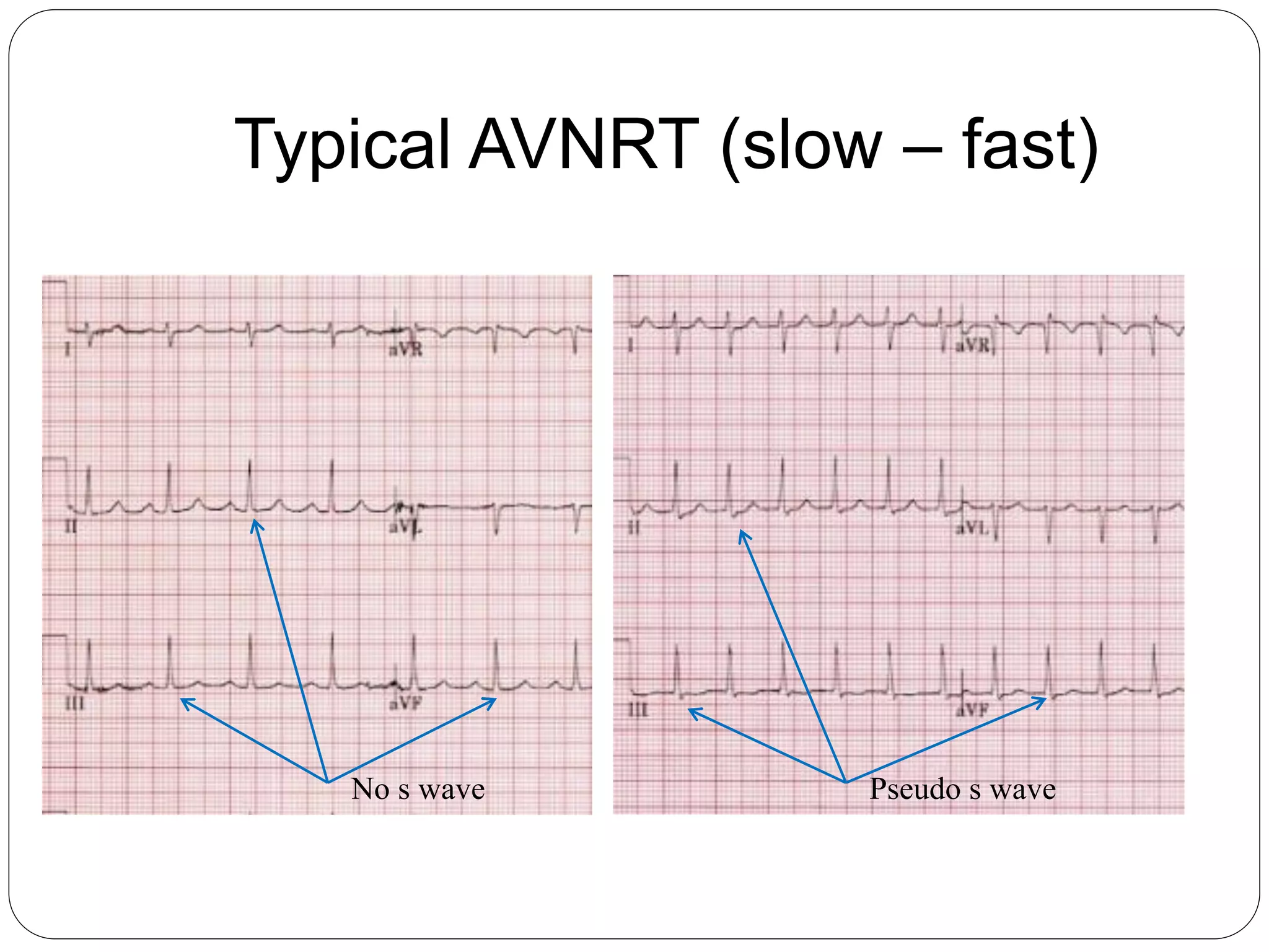 ECG Nhịp nhanh trên thất | PDF