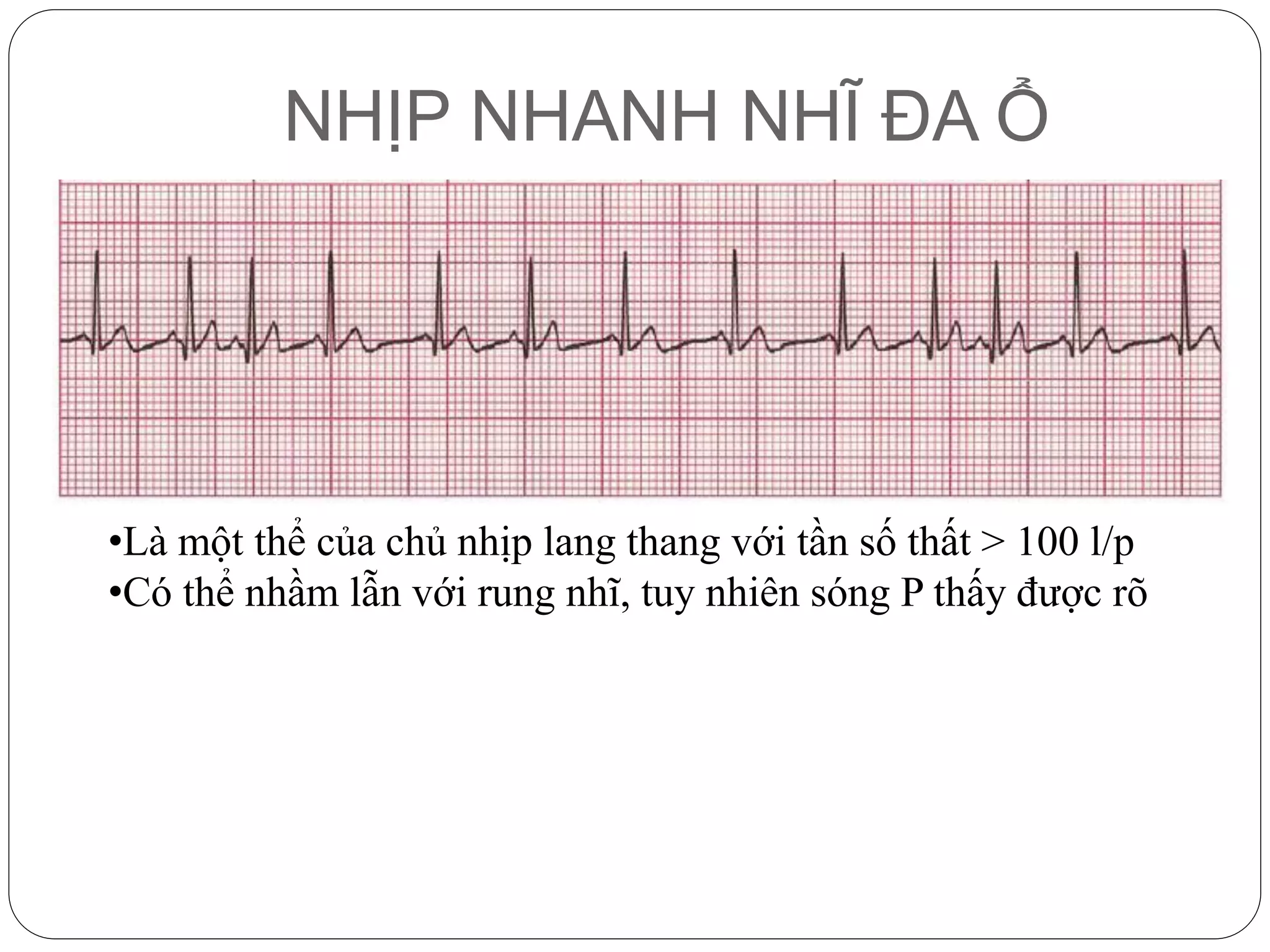 ECG Nhịp nhanh trên thất | PDF