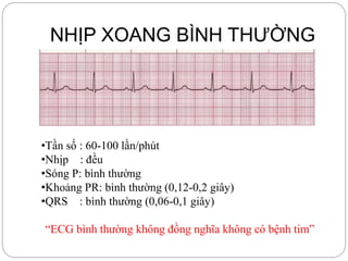ECG Nhịp nhanh trên thất | PDF