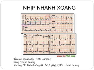 ECG Nhịp nhanh trên thất | PDF
