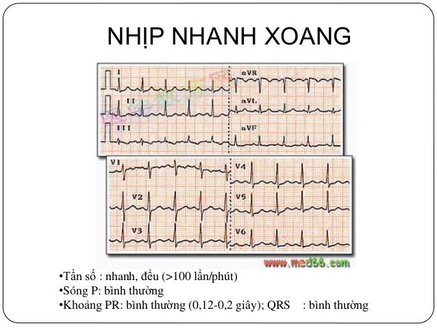 ECG Nhịp nhanh trên thất