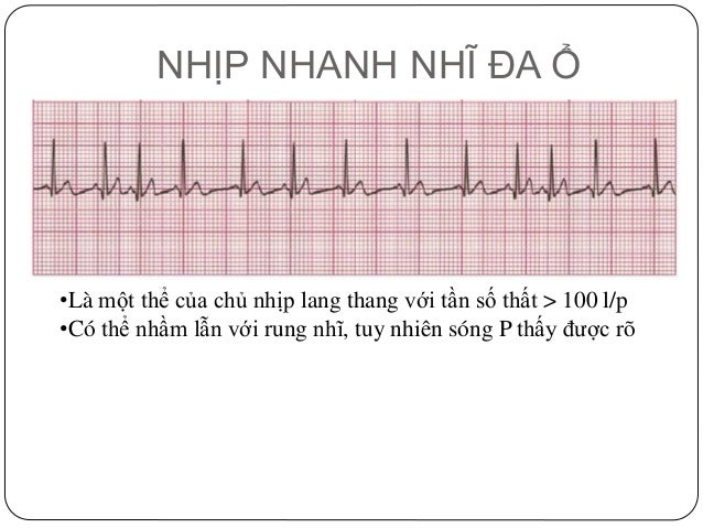ECG Nhịp nhanh trên thất