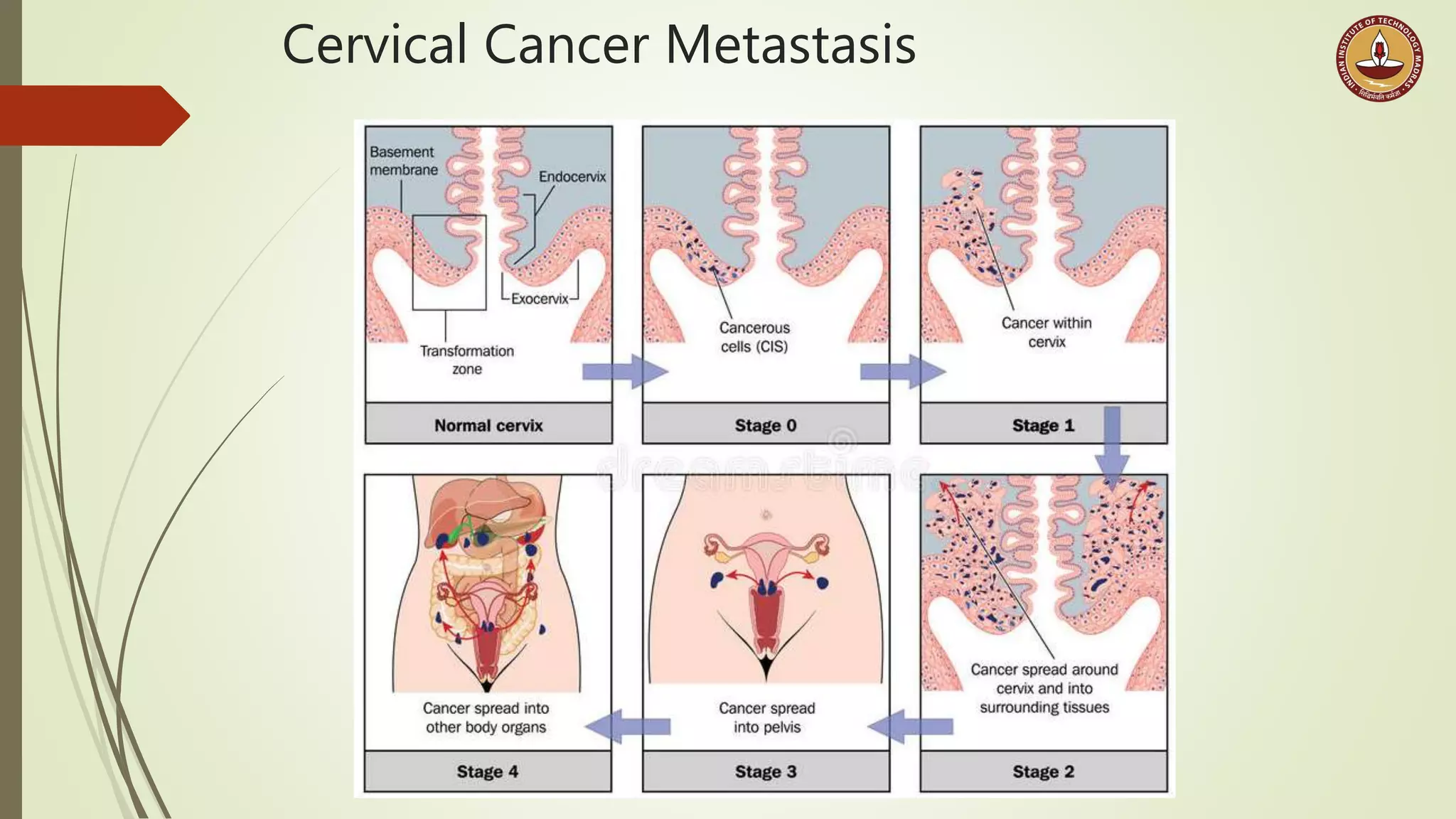 Cervical Cancer Metastasis | PPT