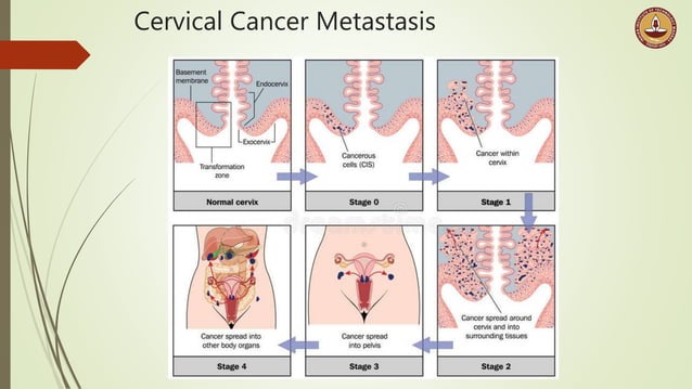 Cervical Cancer Metastasis | PPT