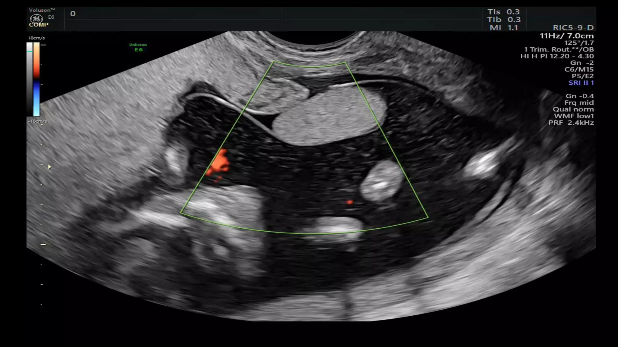 BODY STALK ANOMALY | PDF