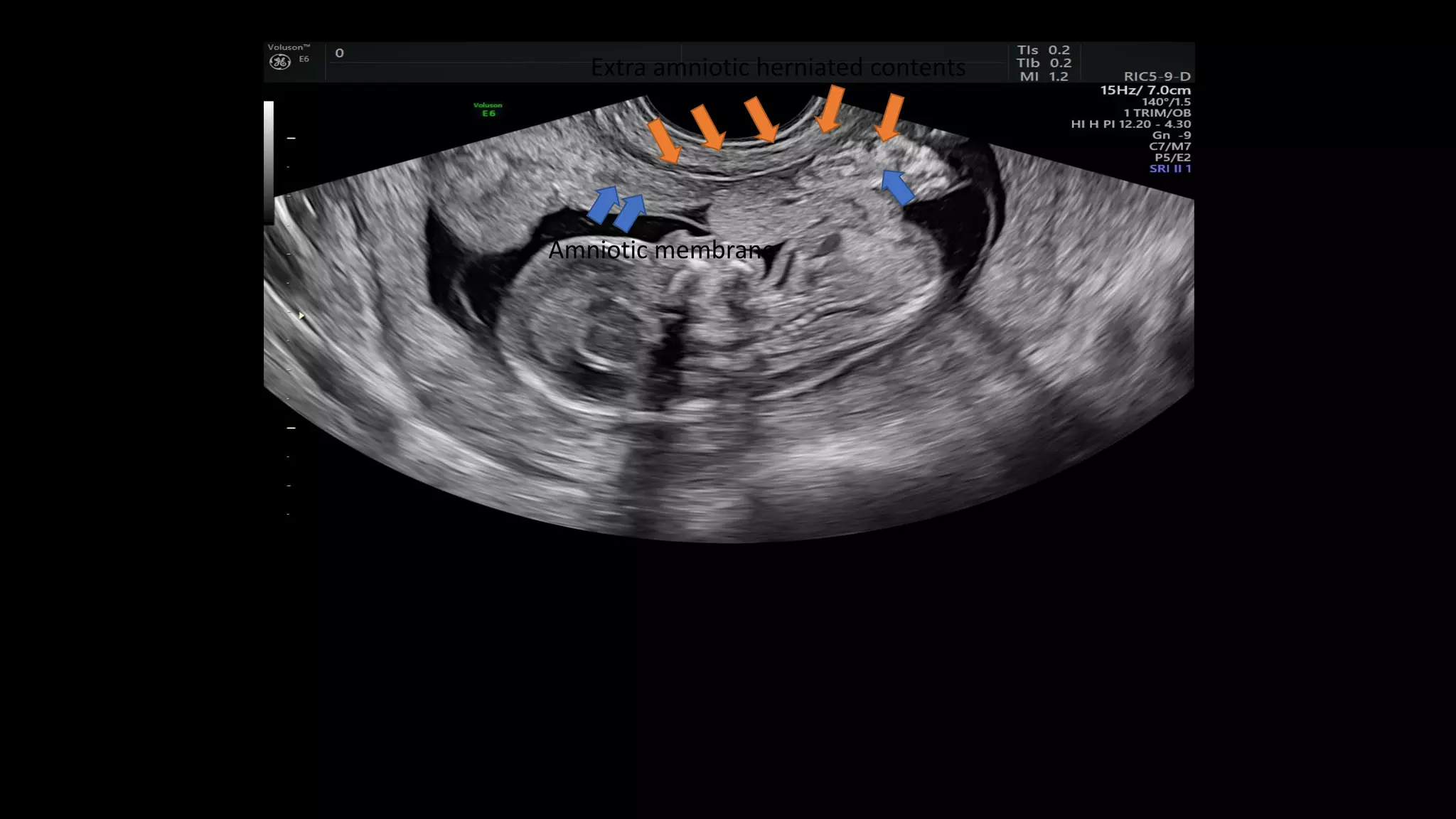 BODY STALK ANOMALY | PDF