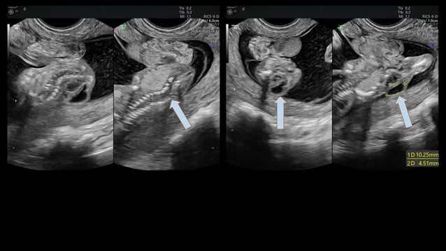 BODY STALK ANOMALY | PDF