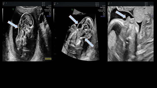 BODY STALK ANOMALY | PDF