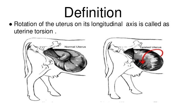 Uterine torsion