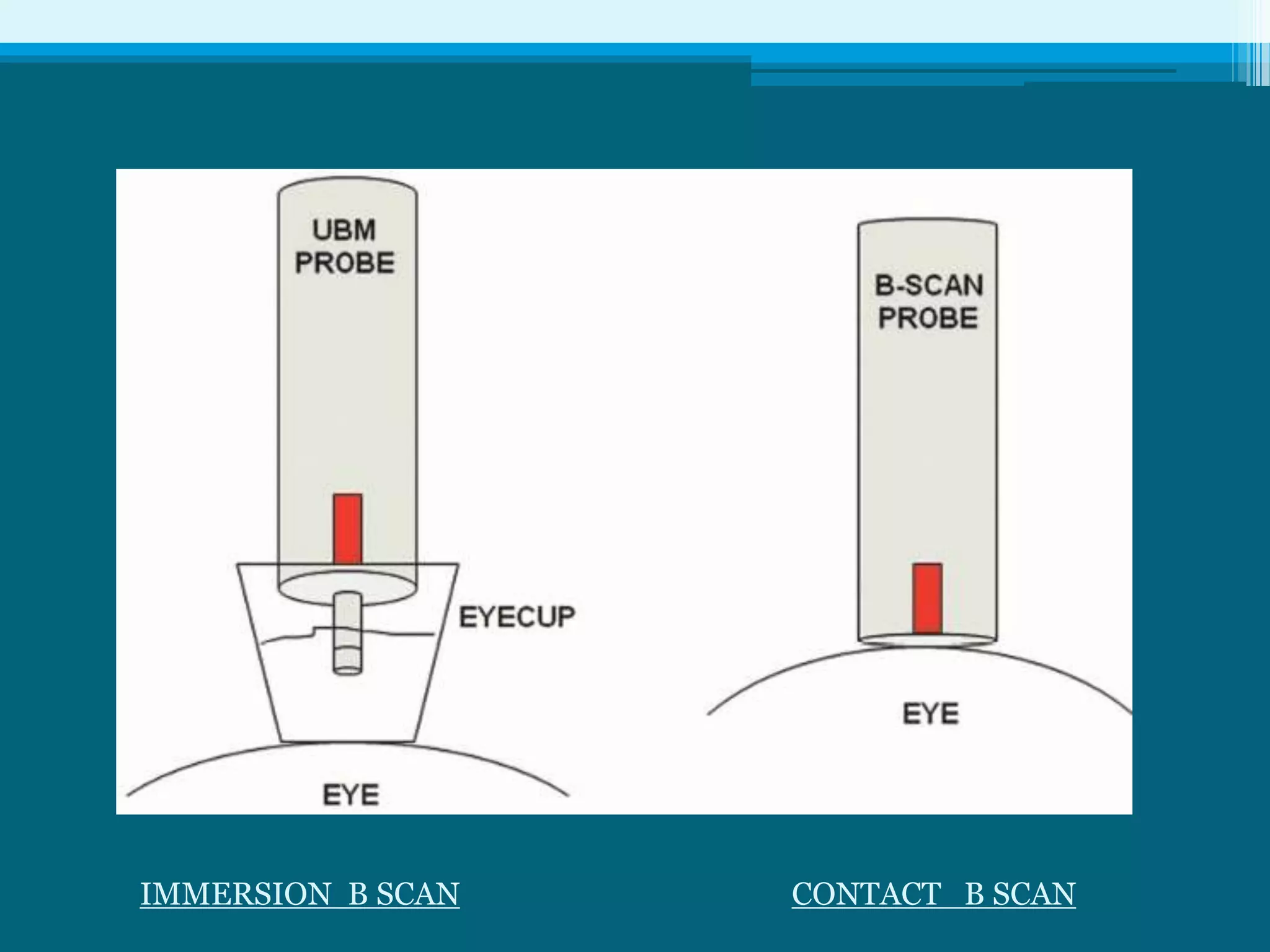 B scan | PPTX | Eye and Vision Conditions | Diseases and Conditions