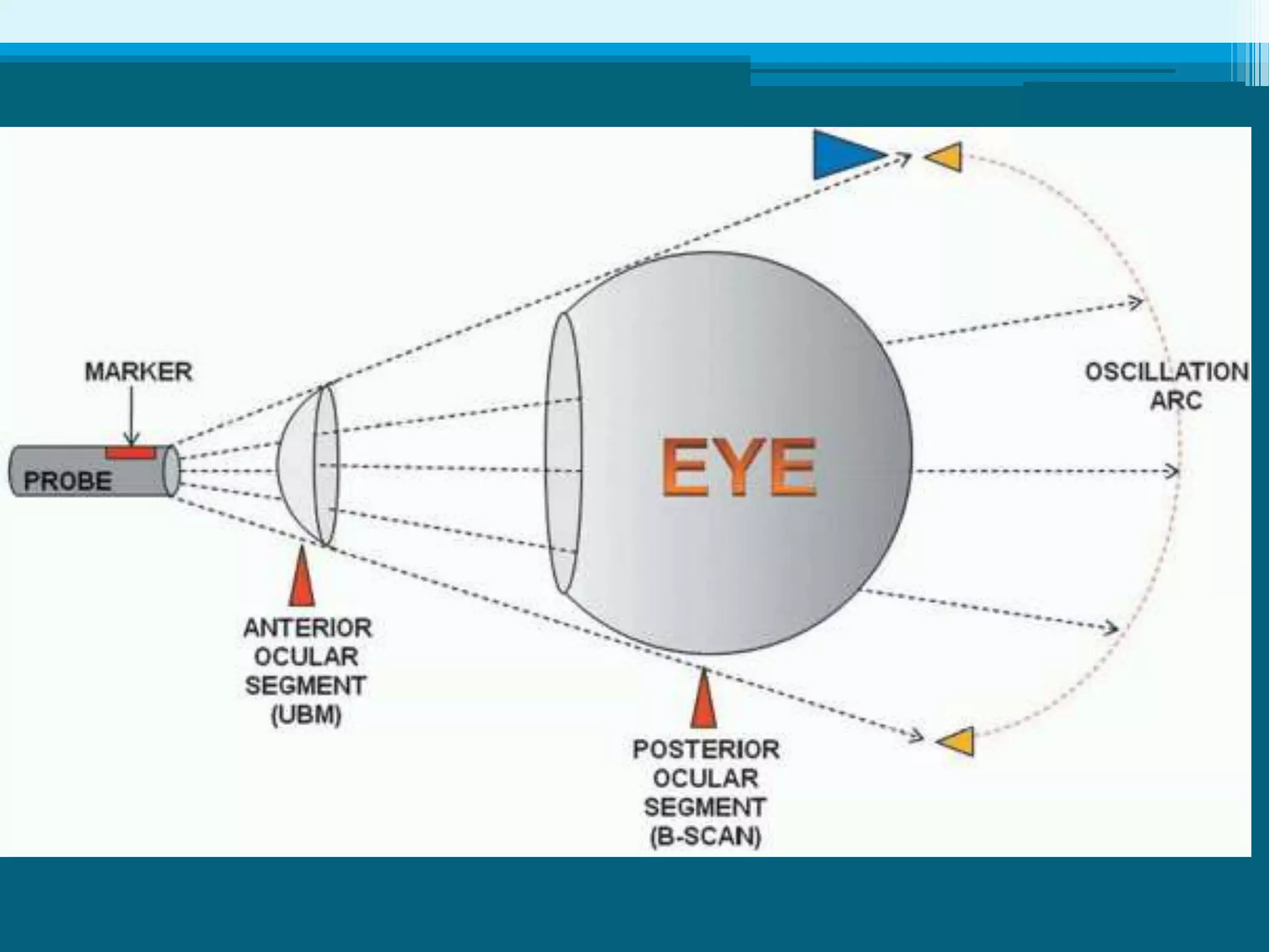 B scan | PPTX | Eye and Vision Conditions | Diseases and Conditions