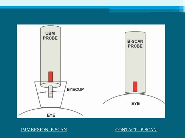 B scan | PPTX | Eye and Vision Conditions | Diseases and Conditions