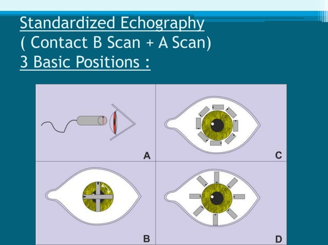B scan | PPTX | Eye and Vision Conditions | Diseases and Conditions