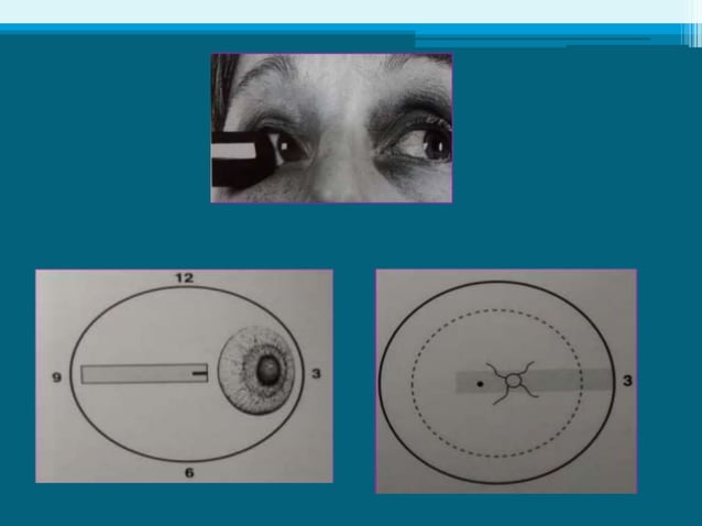 B scan | PPTX | Eye and Vision Conditions | Diseases and Conditions
