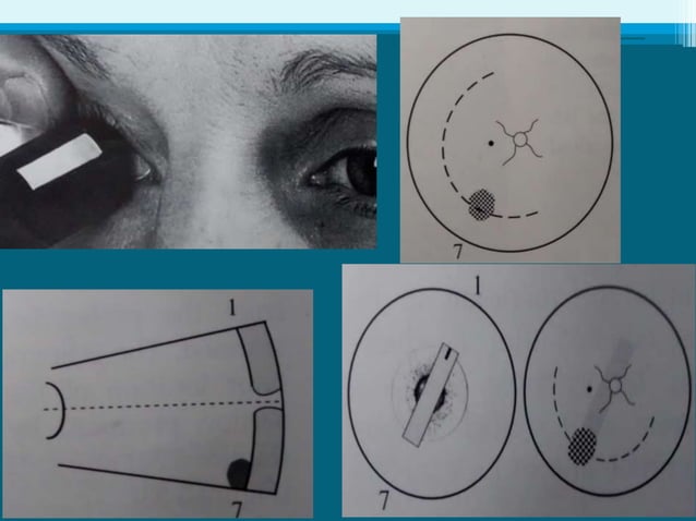 B scan | PPTX | Eye and Vision Conditions | Diseases and Conditions