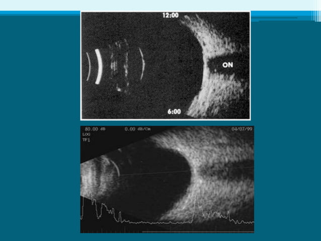 B scan | PPTX | Eye and Vision Conditions | Diseases and Conditions