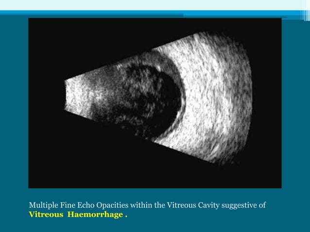 B scan | PPTX | Eye and Vision Conditions | Diseases and Conditions