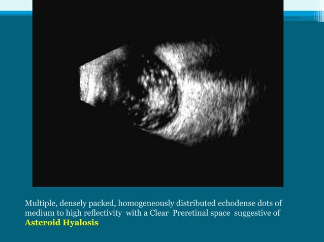 B scan | PPTX | Eye and Vision Conditions | Diseases and Conditions