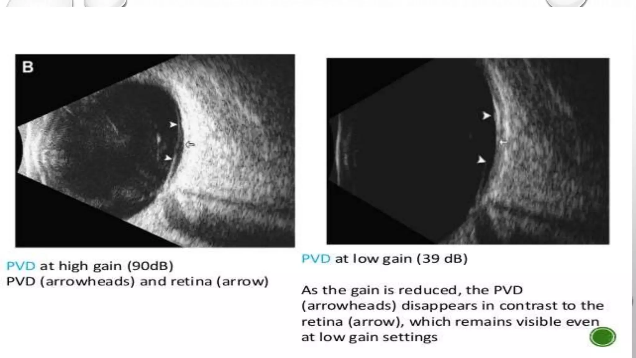 Ultrasound of eye - B scan | PPTX