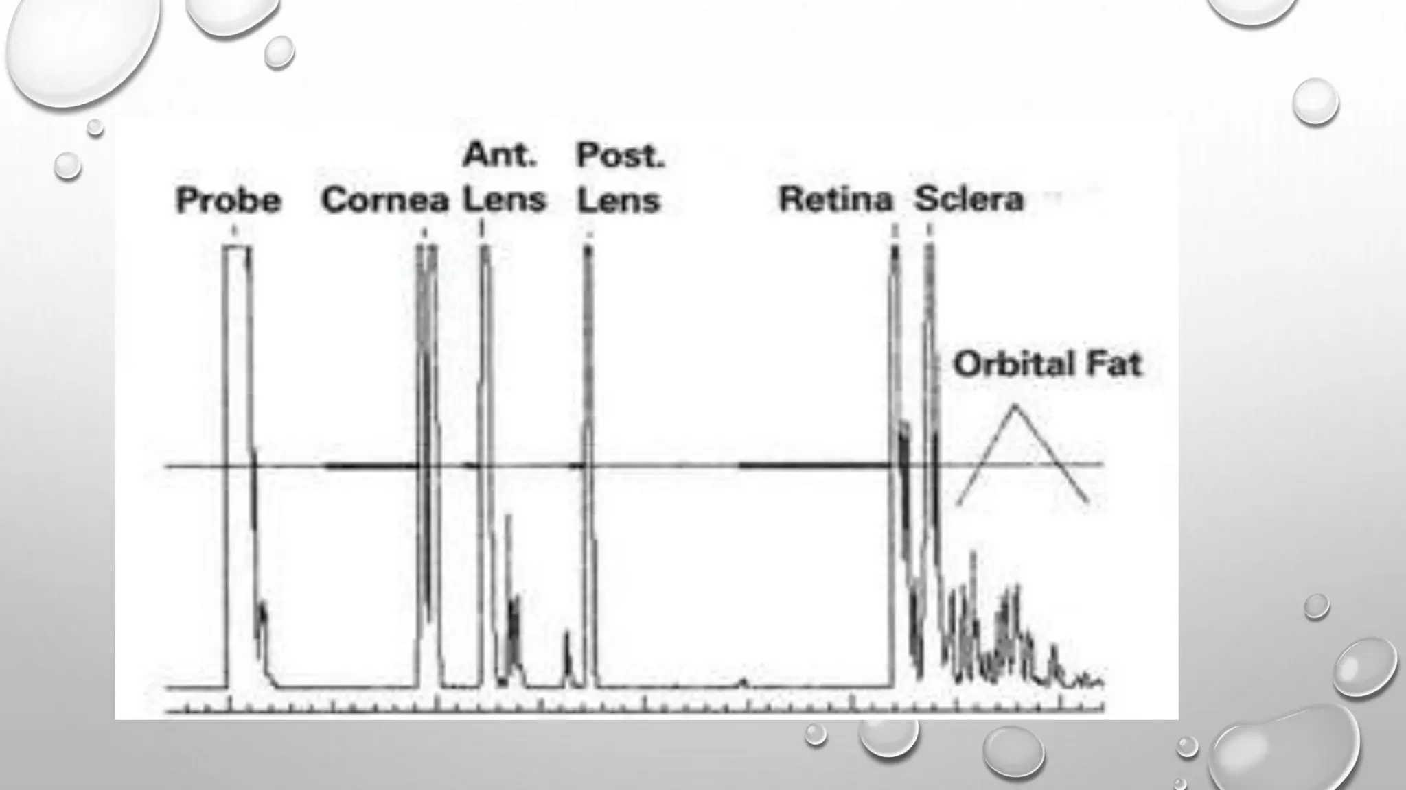 Ultrasound of eye - B scan | PPTX