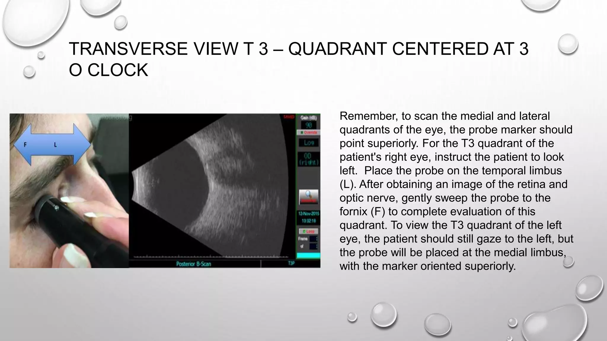Ultrasound of eye - B scan | PPTX