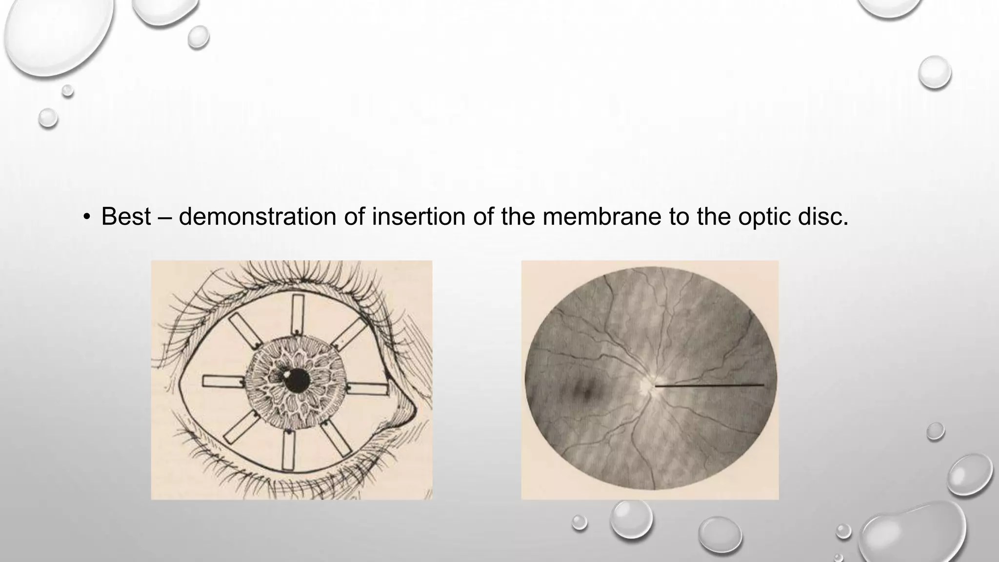 Ultrasound of eye - B scan | PPTX