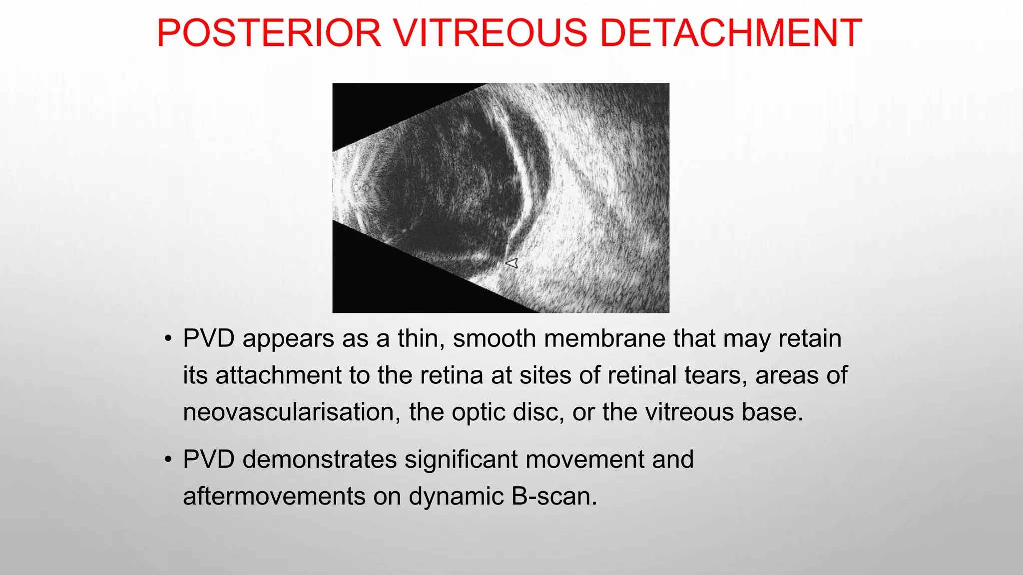 Ultrasound of eye - B scan | PPTX