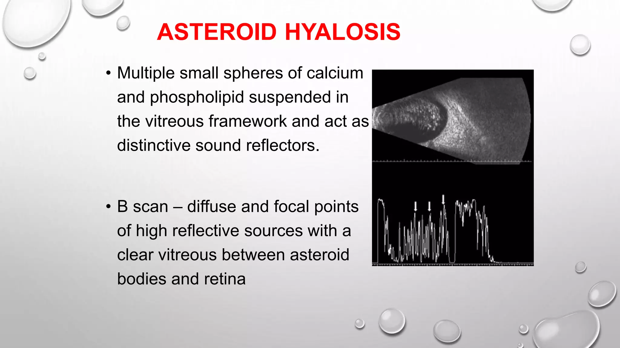 Ultrasound of eye - B scan | PPTX