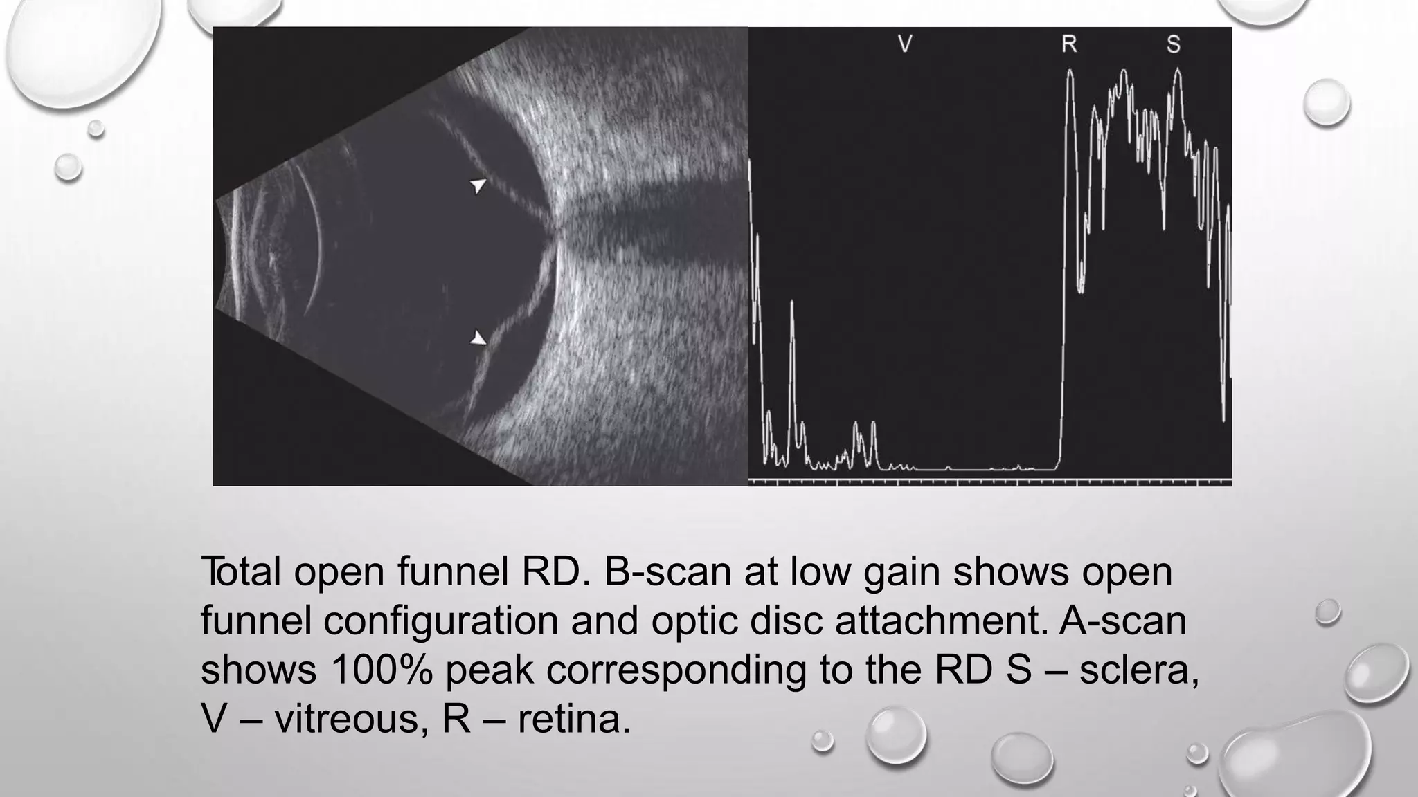 Ultrasound of eye - B scan | PPTX