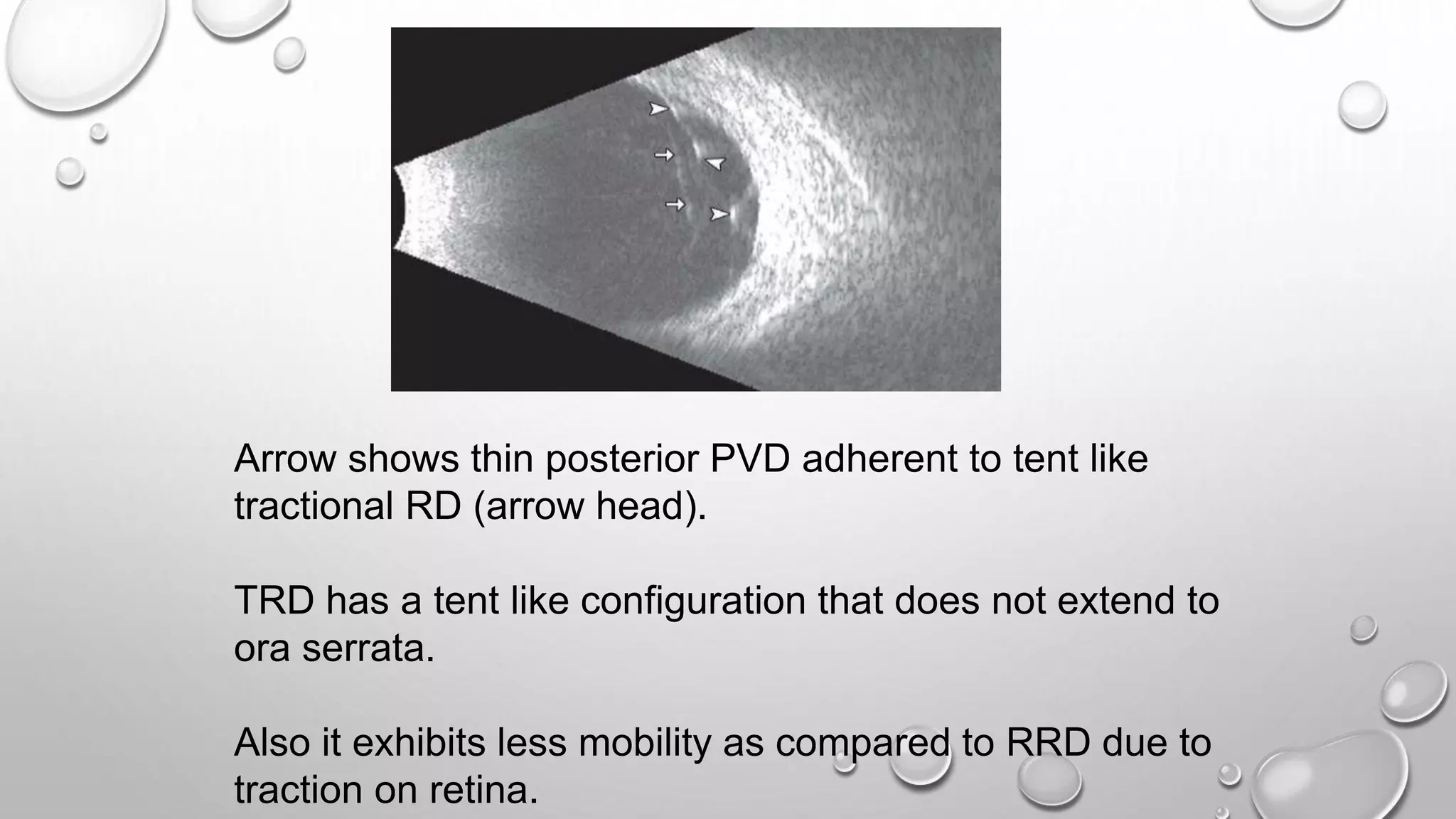 Ultrasound of eye - B scan | PPTX