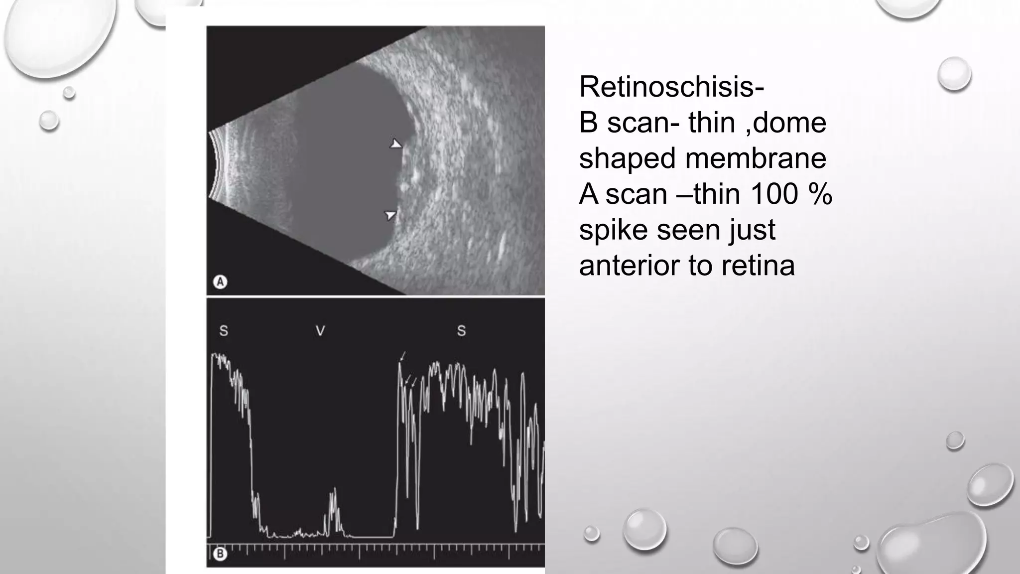 Ultrasound of eye - B scan | PPTX