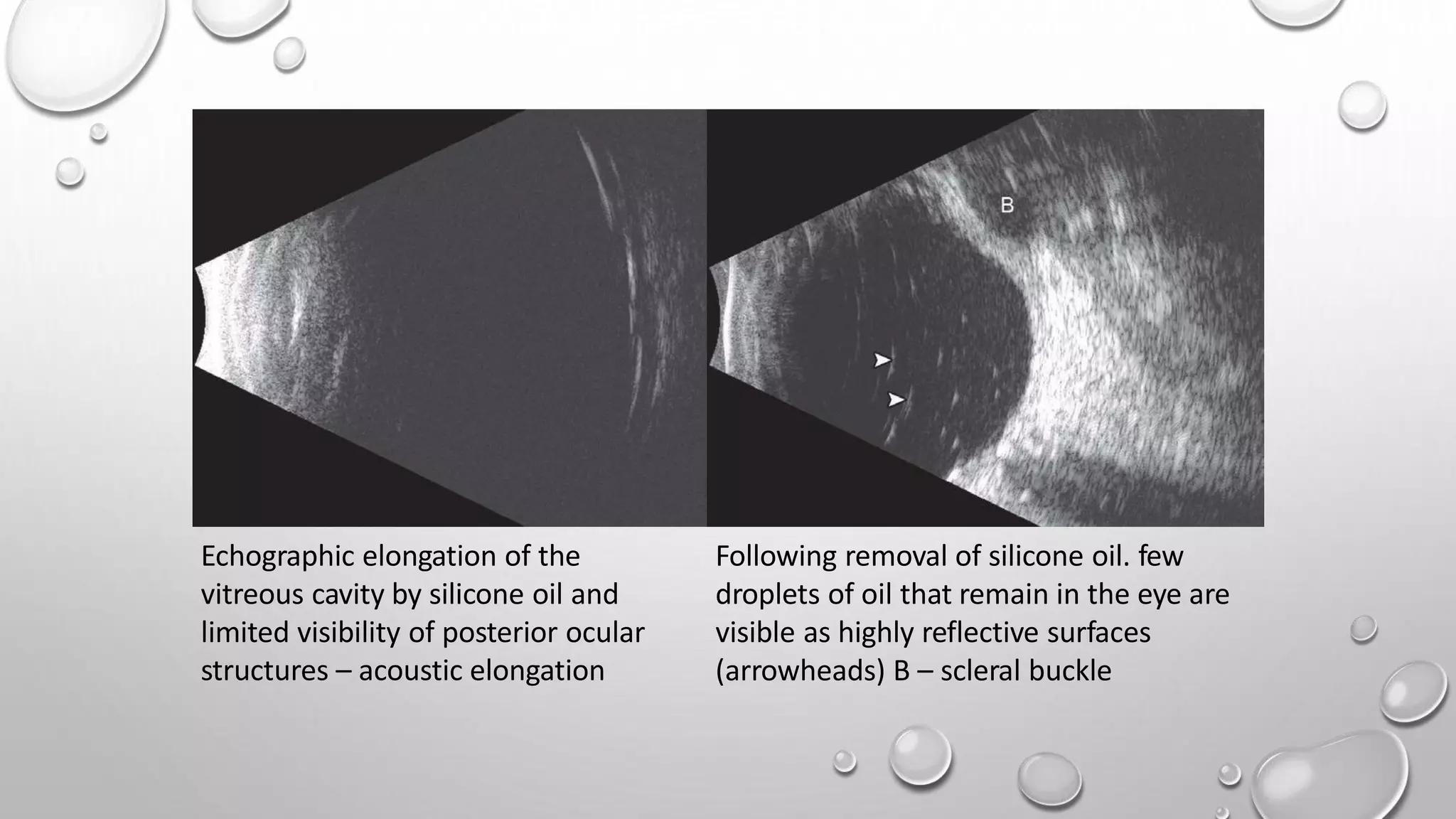 Ultrasound of eye - B scan | PPTX