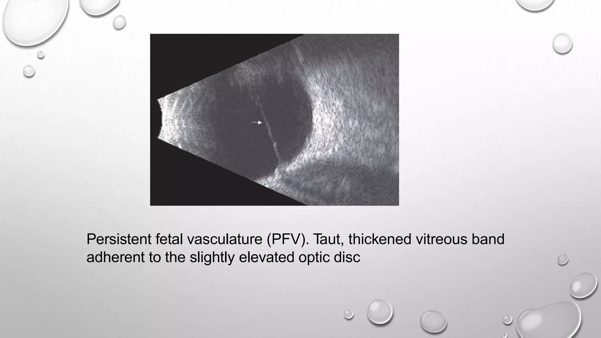 Ultrasound of eye - B scan | PPTX