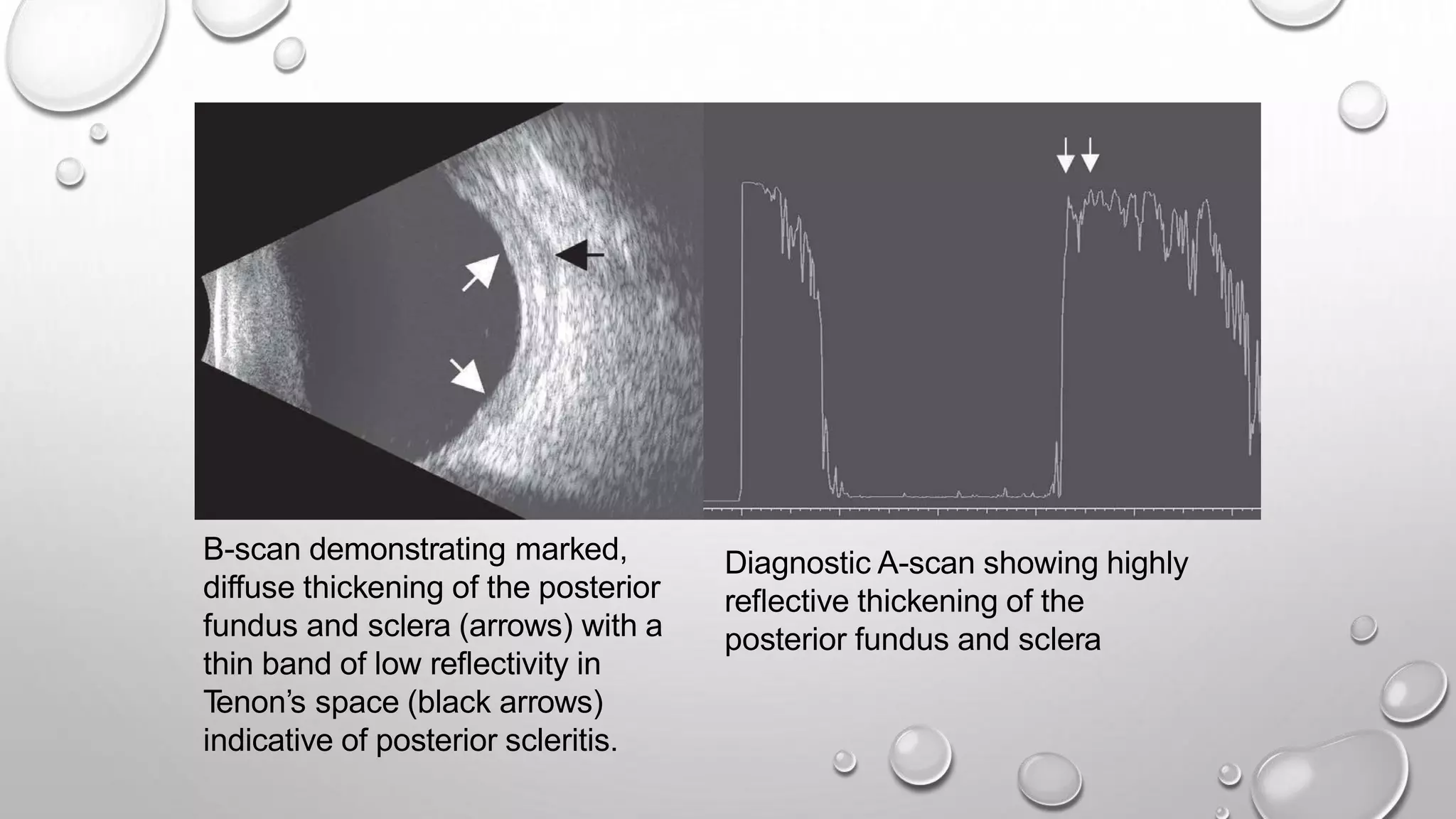 Ultrasound of eye - B scan | PPTX