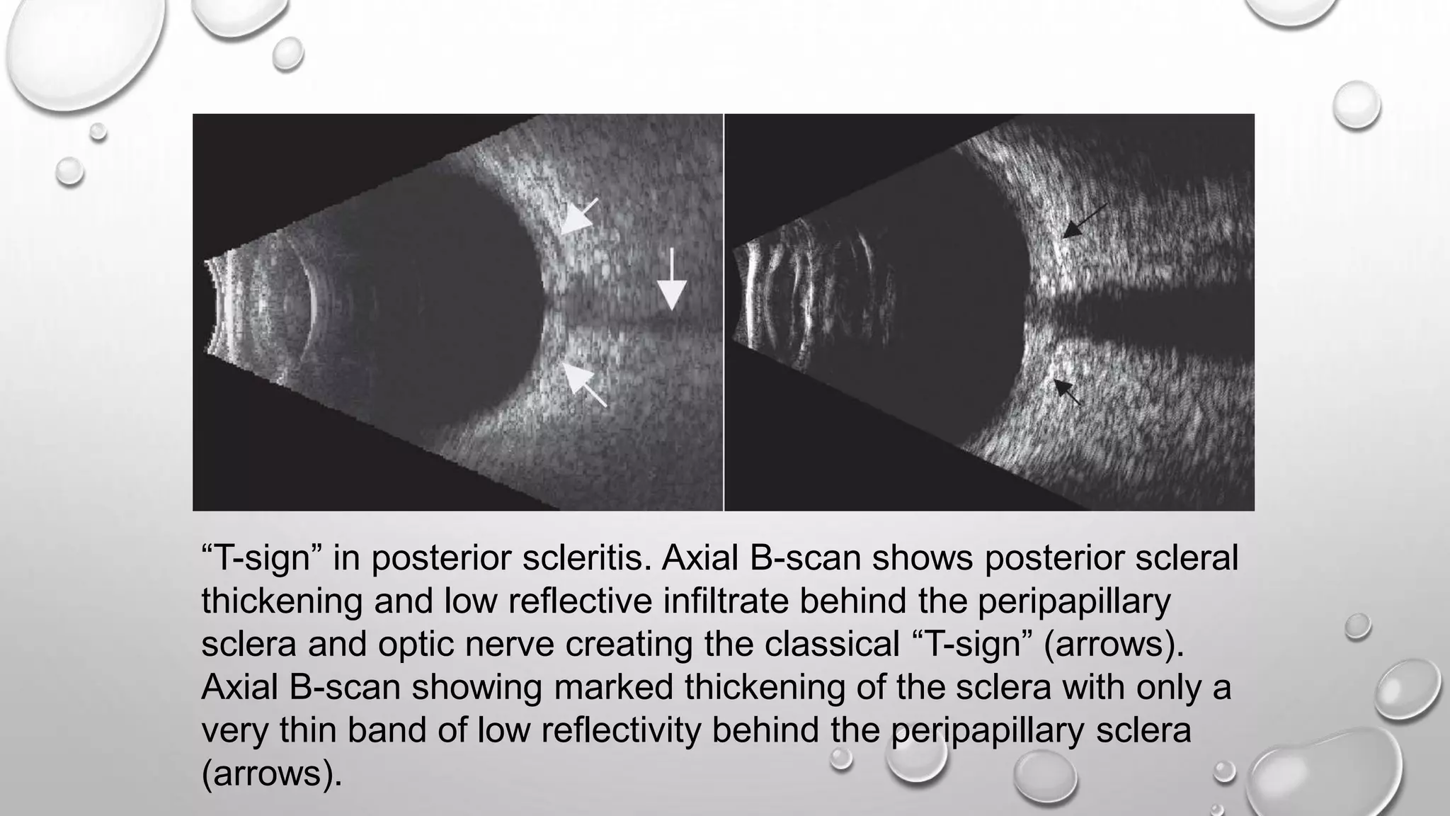 Ultrasound of eye - B scan | PPTX