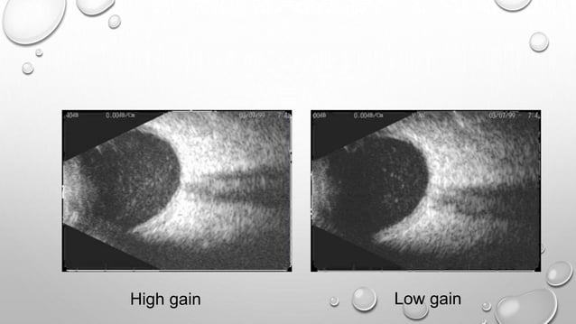 Ultrasound of eye - B scan | PPTX | Digital Audio | Computer Software and Applications
