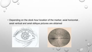 Ultrasound of eye - B scan | PPTX