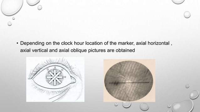 Ultrasound of eye - B scan | PPTX | Digital Audio | Computer Software ...