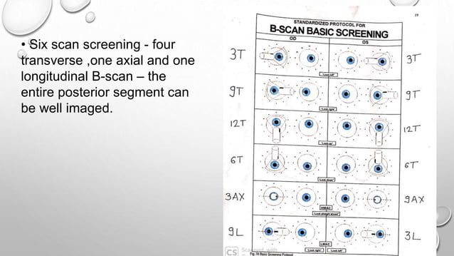 Ultrasound of eye - B scan | PPTX | Digital Audio | Computer Software ...