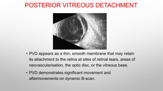 Ultrasound of eye - B scan | PPTX