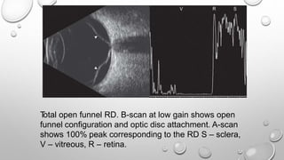 Ultrasound of eye - B scan | PPTX